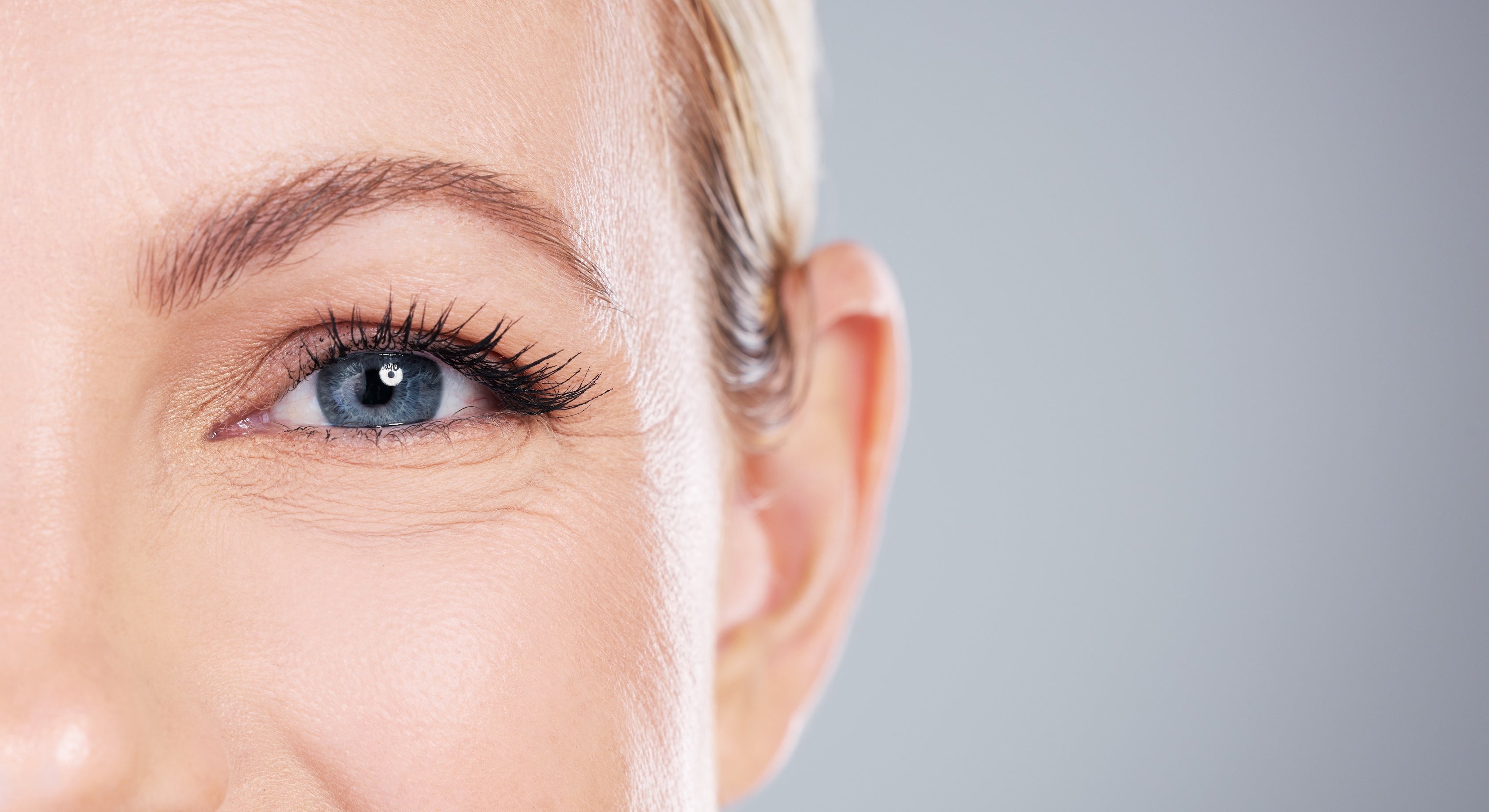 Crows Feet – Skin Rejuvenation Clinic